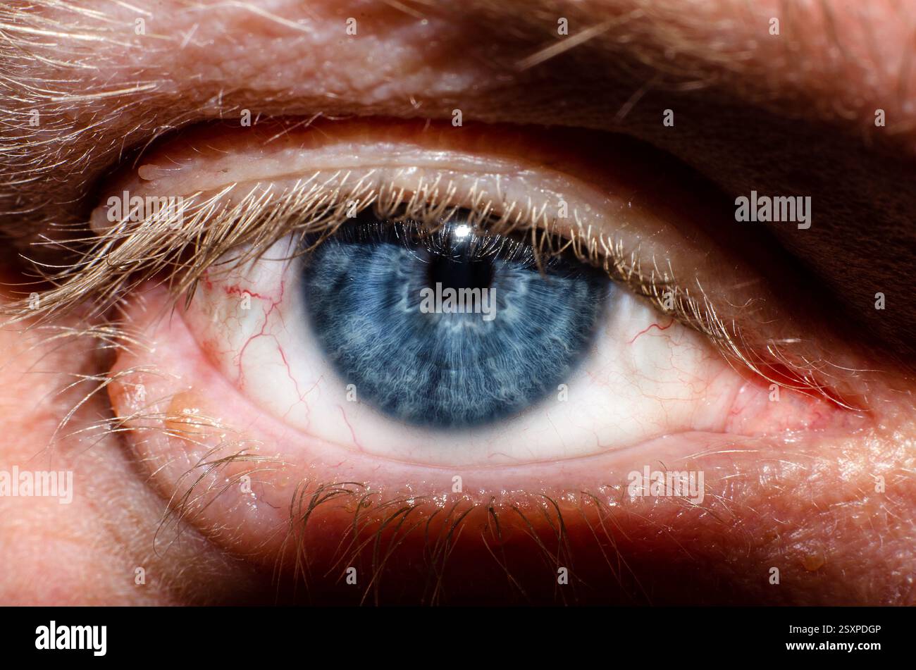 Papilloma on the eyelid hi-res stock photography and images - Alamy