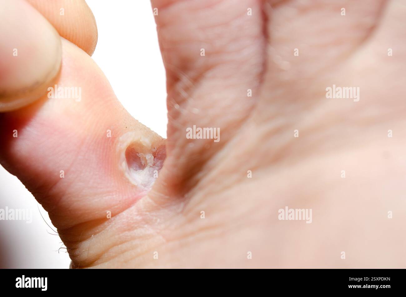 Fungal infection between the toes of the adult man close up Stock Photo ...