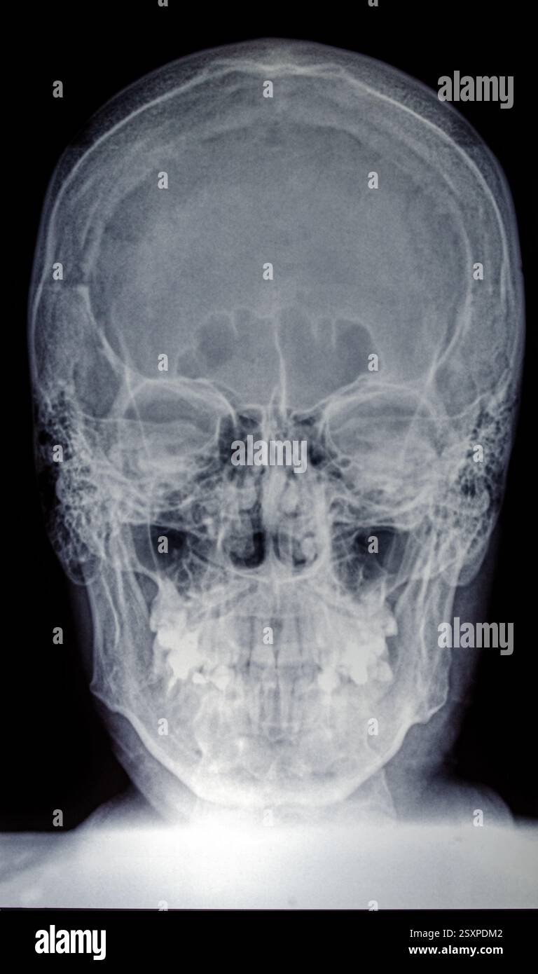 X-ray of the skull of an adult male Stock Photo - Alamy
