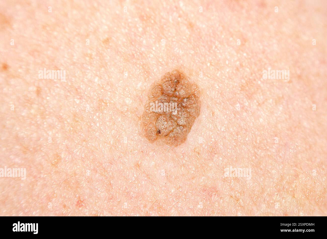 Papilloma mole on human skin Stock Photo - Alamy