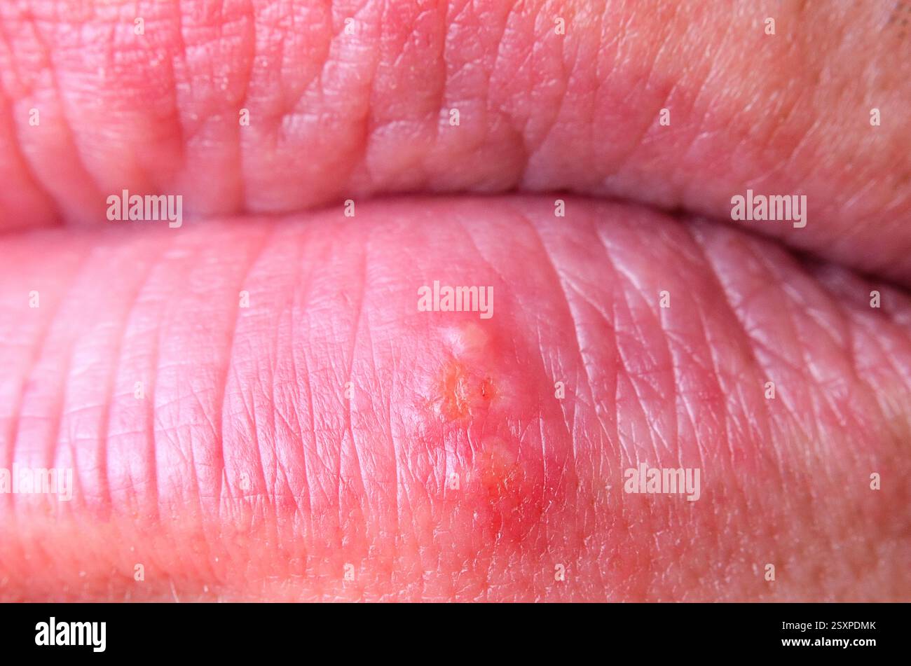 Herpes virus on the lower lip of an adult male close-up Stock Photo - Alamy