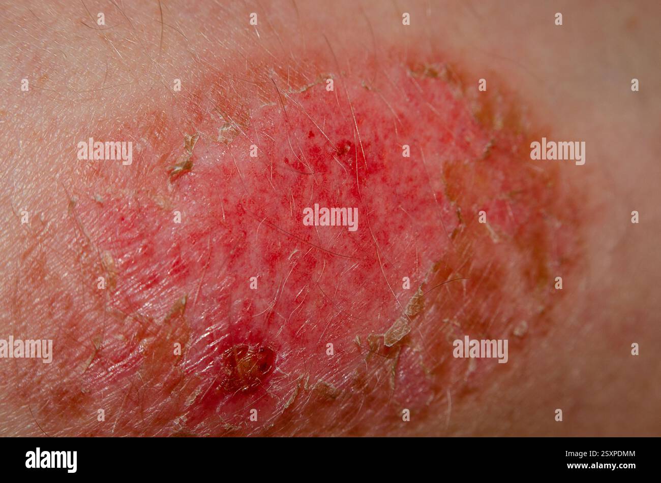 Wound after burn on human body Stock Photo - Alamy
