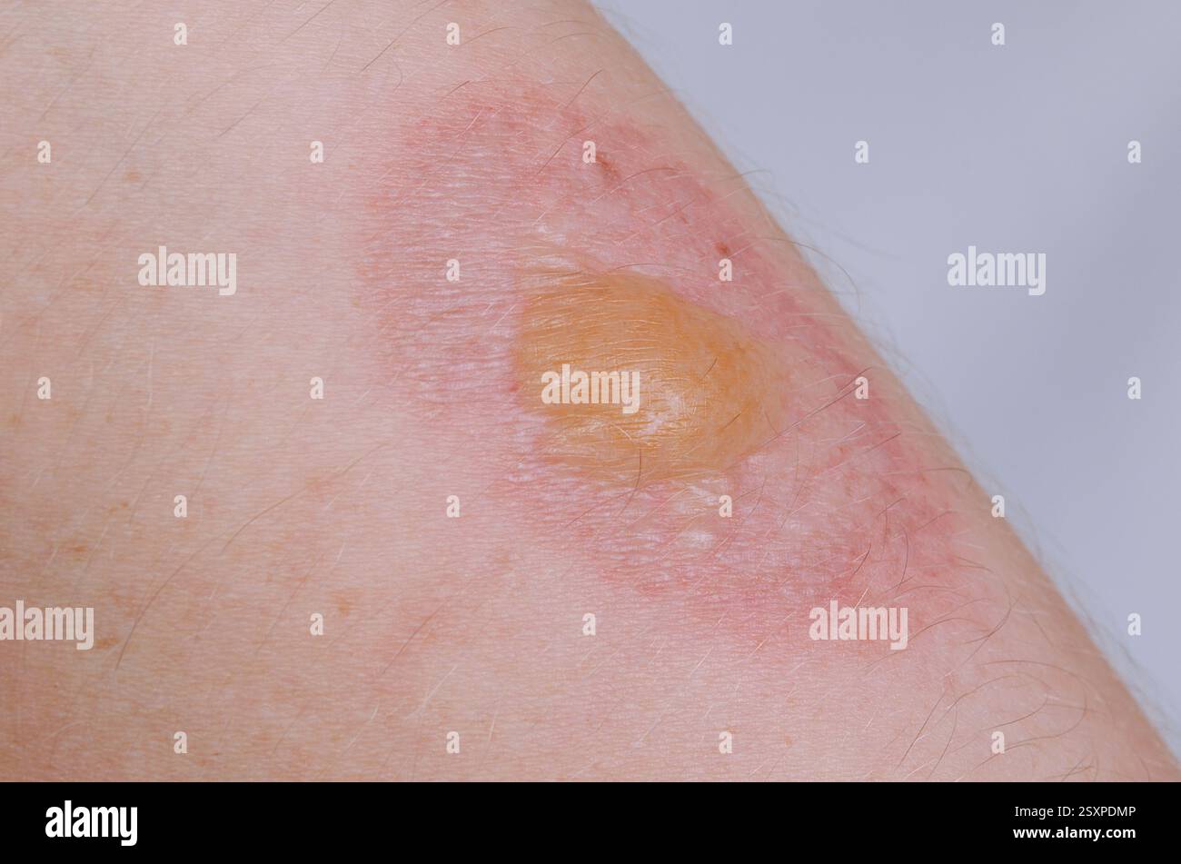 Burn on human skin Stock Photo - Alamy