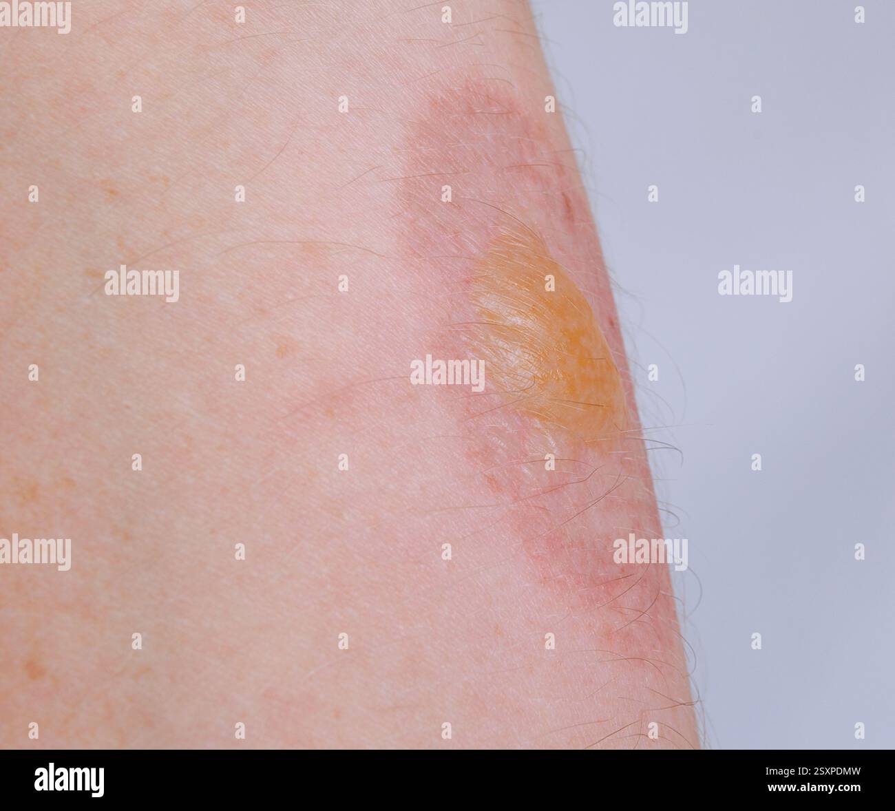 Burn on human skin Stock Photo - Alamy