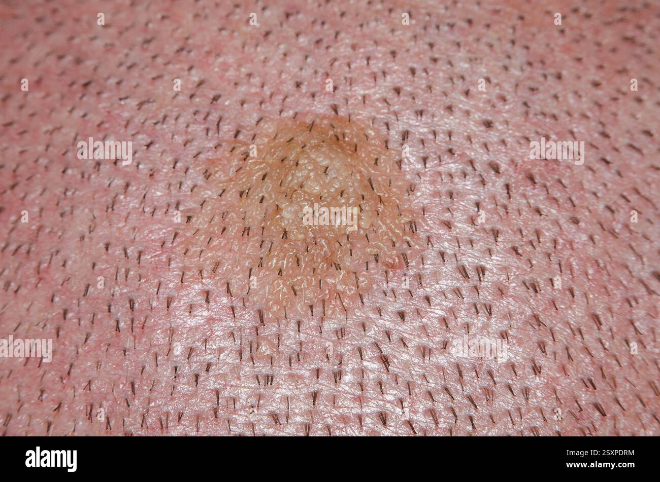 Birthmark or keratoma on the scalp of a young male close-up Stock Photo ...