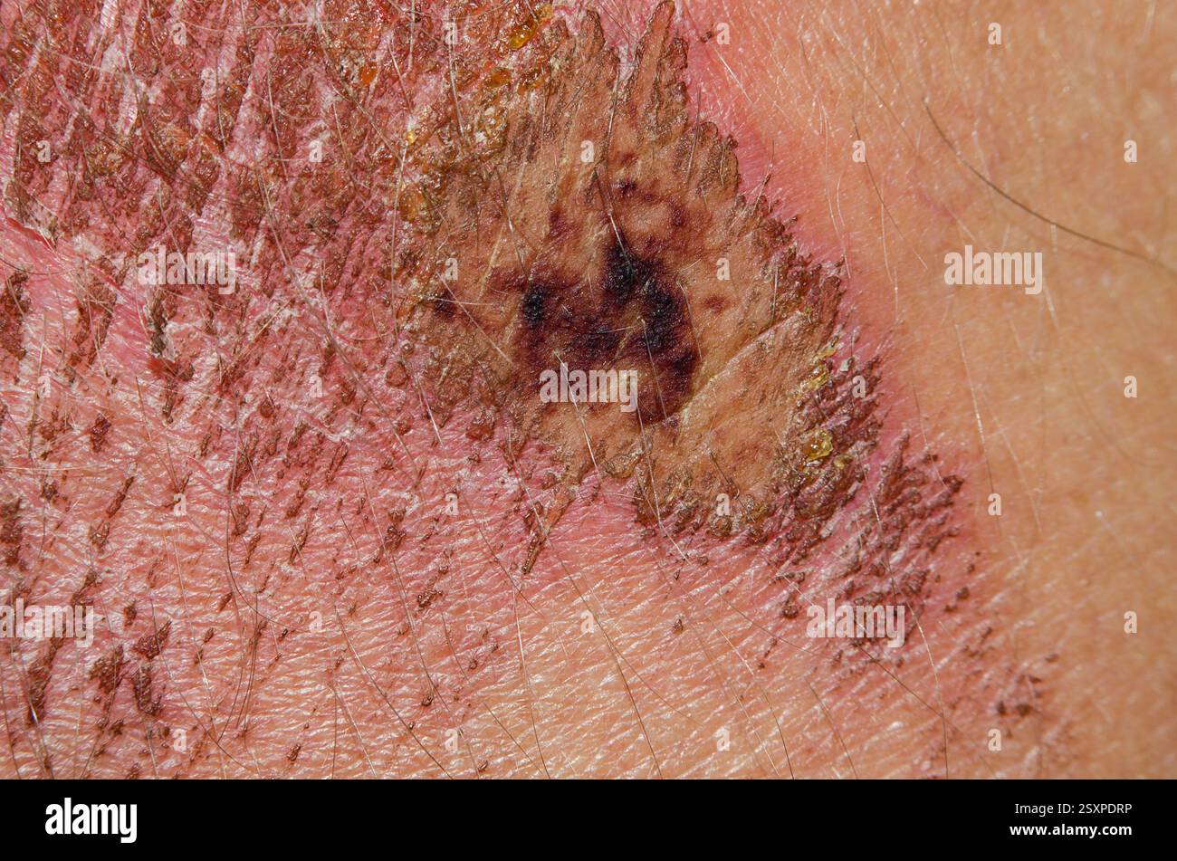 Purulent wound on the skin of the human body Stock Photo - Alamy