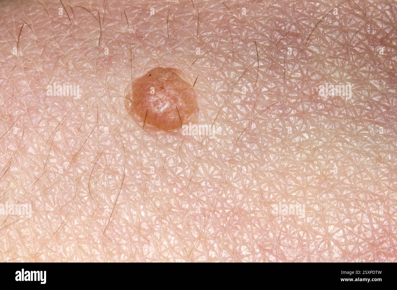 Birthmark, papilloma or benign tumor on the skin of a young woman close ...