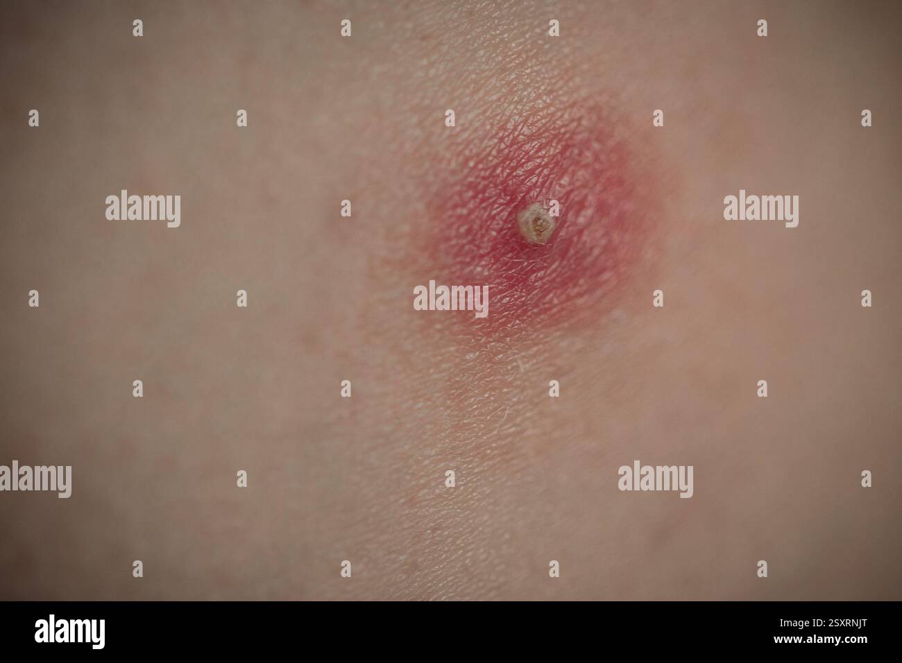 Infected and closed skin glands by staphylococcus. Bulge in skin due to ...