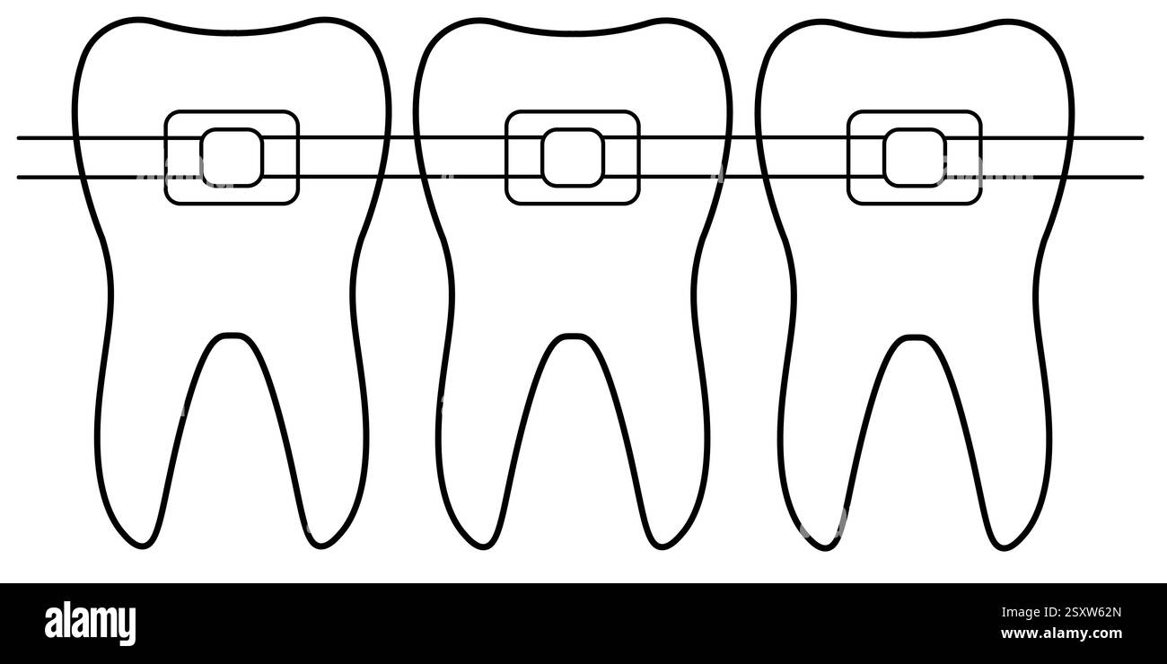 Orthodontic Vector Illustration Showing Braces on Teeth with Dental ...