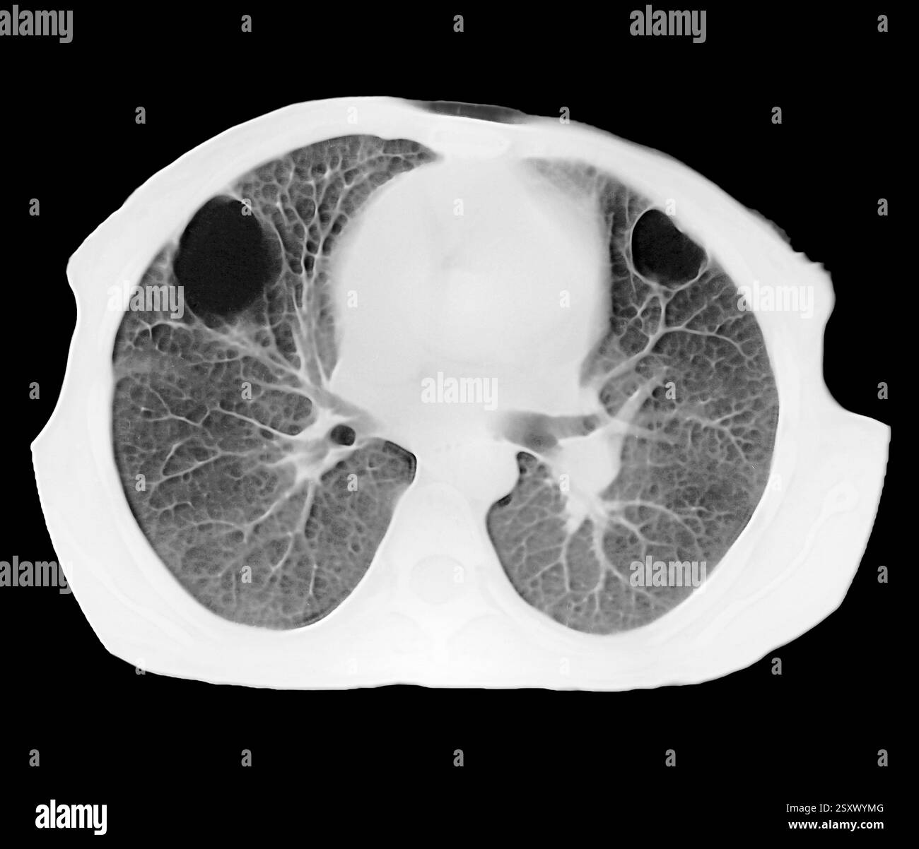 Computed tomography (CT) scan in axial view of the lungs of a 47 year ...