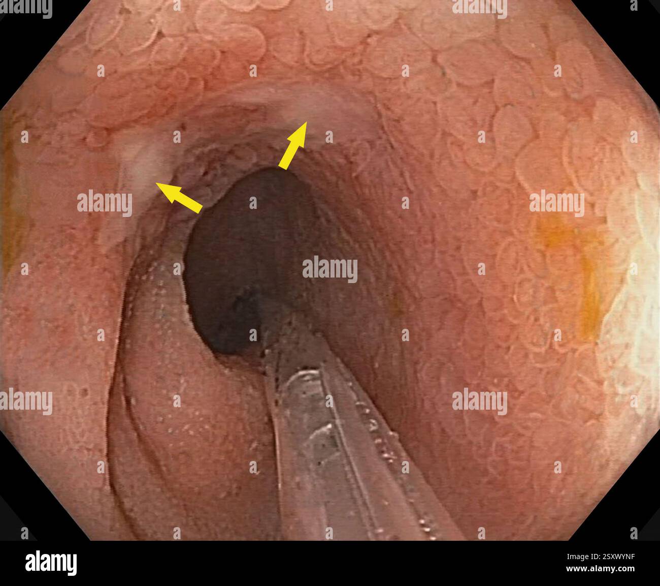 Crohn's disease, endoscope view Stock Photo - Alamy
