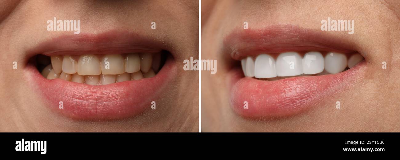 Woman smiling before and after procedure dental veneers placement ...