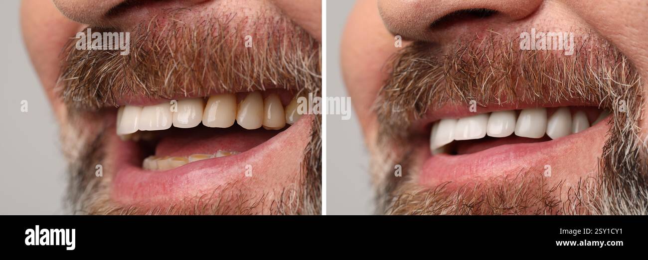 Man smiling before and after procedure dental veneers placement on grey ...