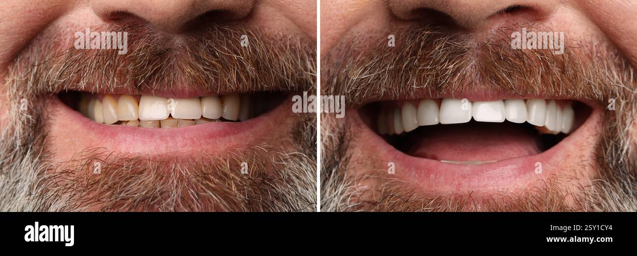 Man smiling before and after procedure dental veneers placement ...