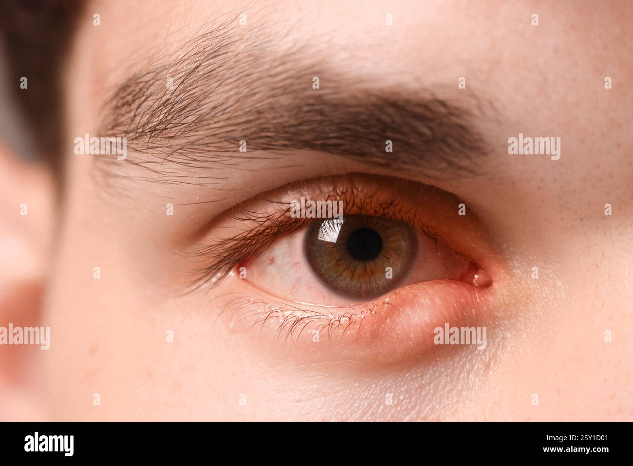 Conjunctivitis. Young man with infected eye, closeup Stock Photo - Alamy