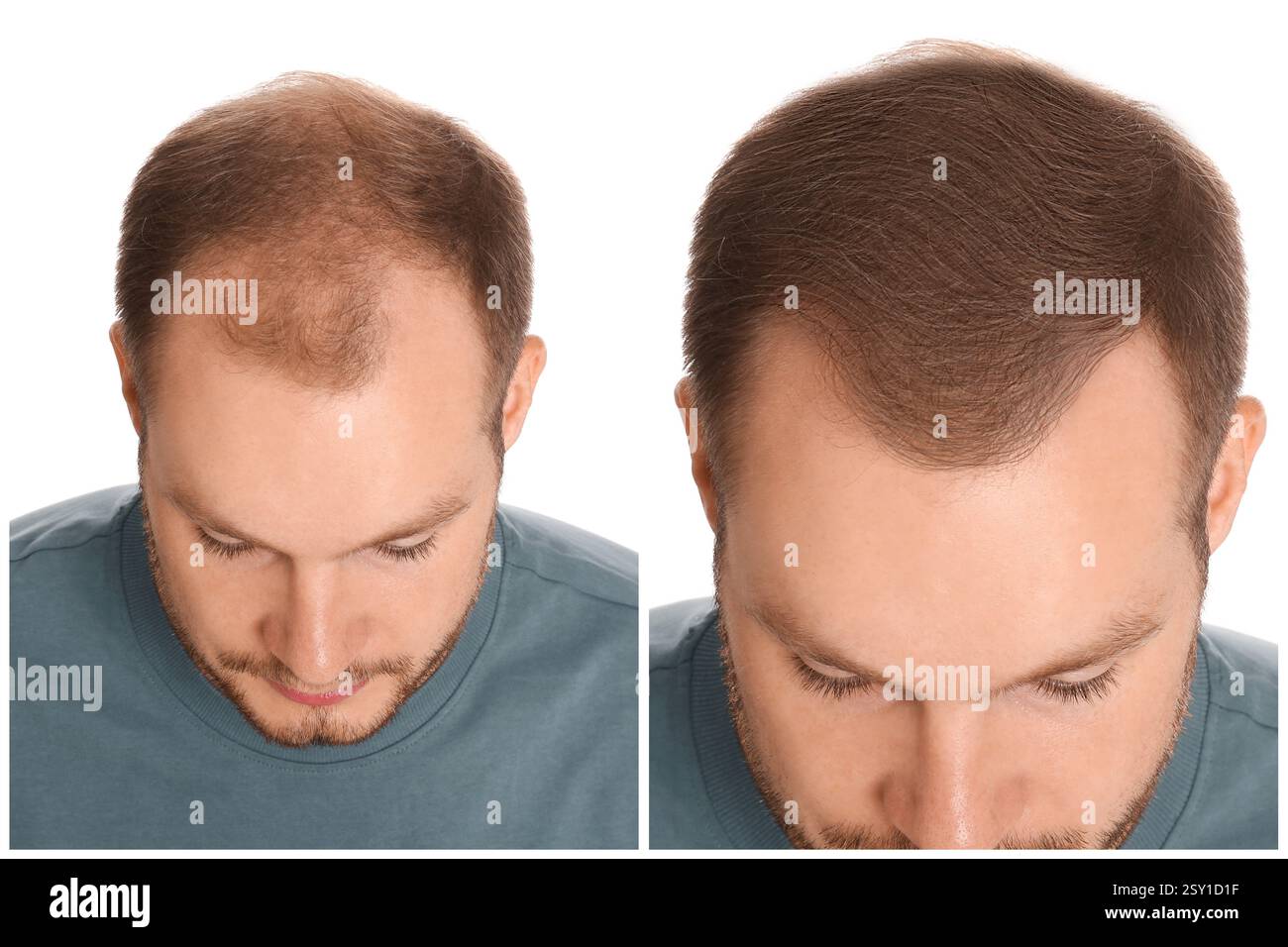 Man with hair loss problem before and after treatment on white ...