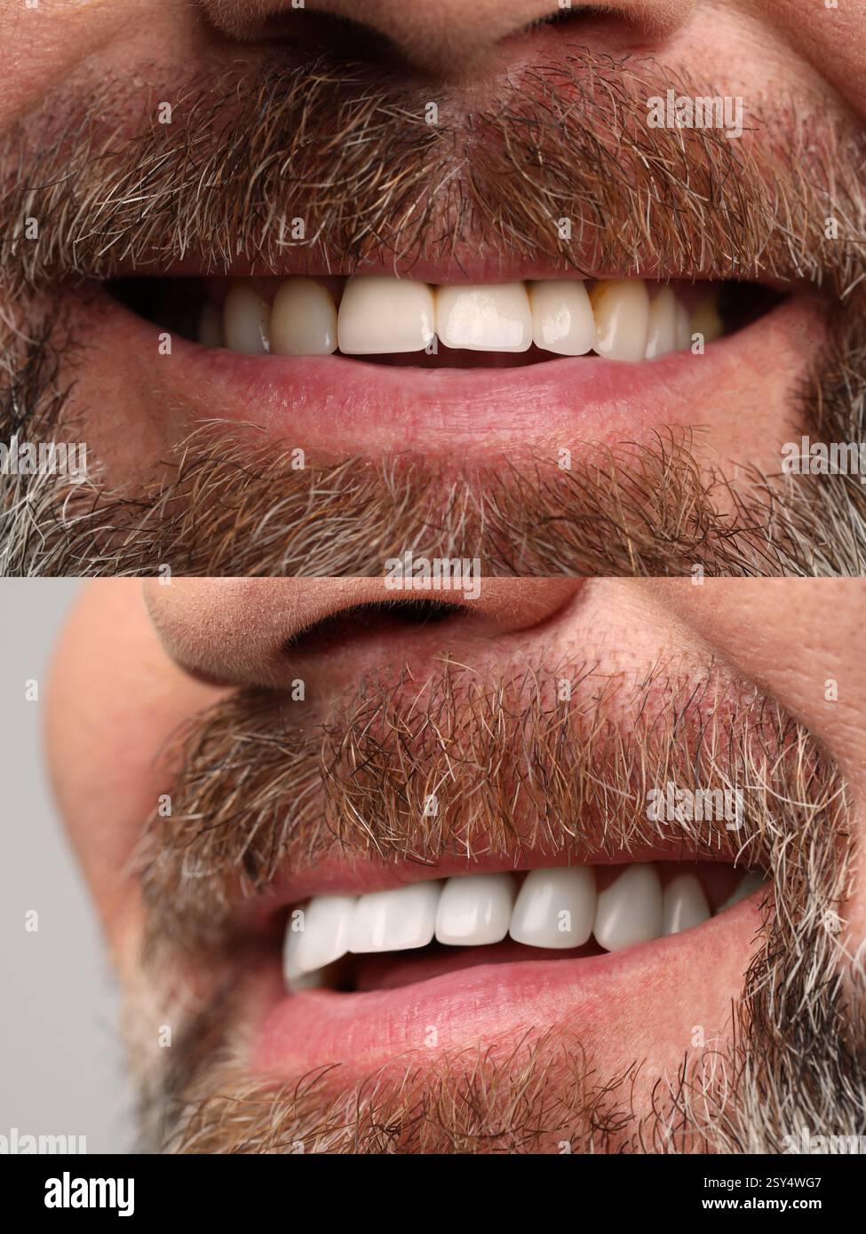 Man smiling before and after procedure dental veneers placement ...