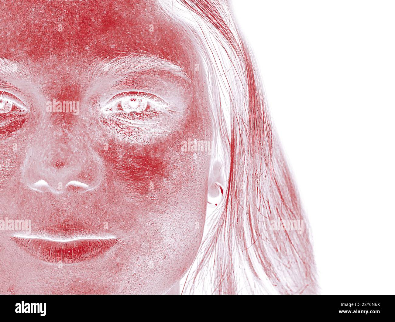 Close-up of sunburned face skin after sunbathing in a girl with rosacea ...