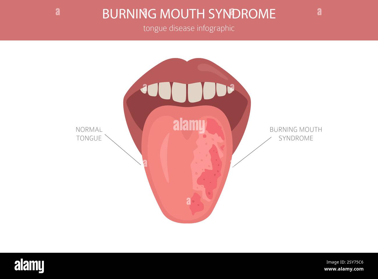 Burning mouth syndrome diseases. Oral medisine. Medical infographic ...