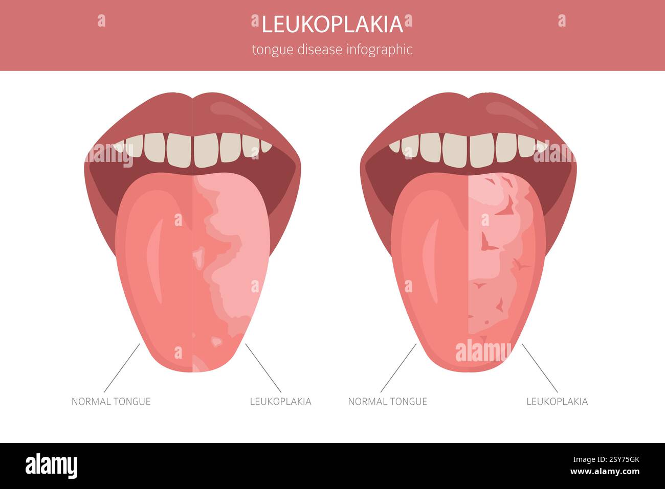 Leukoplakia tongue disease. Oral medicine. Medical infographic design ...