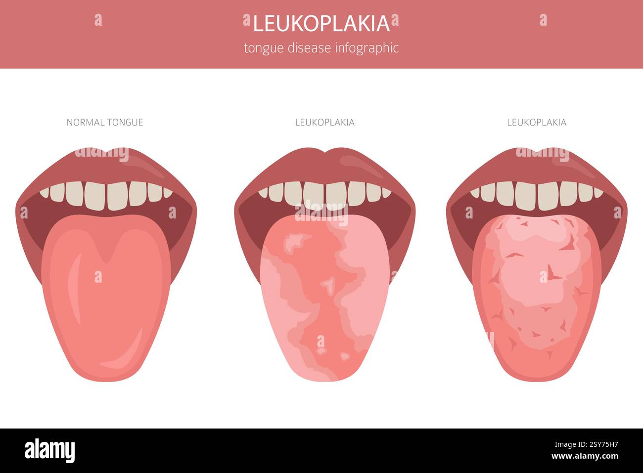 Leukoplakia tongue disease. Oral medicine. Medical infographic design ...