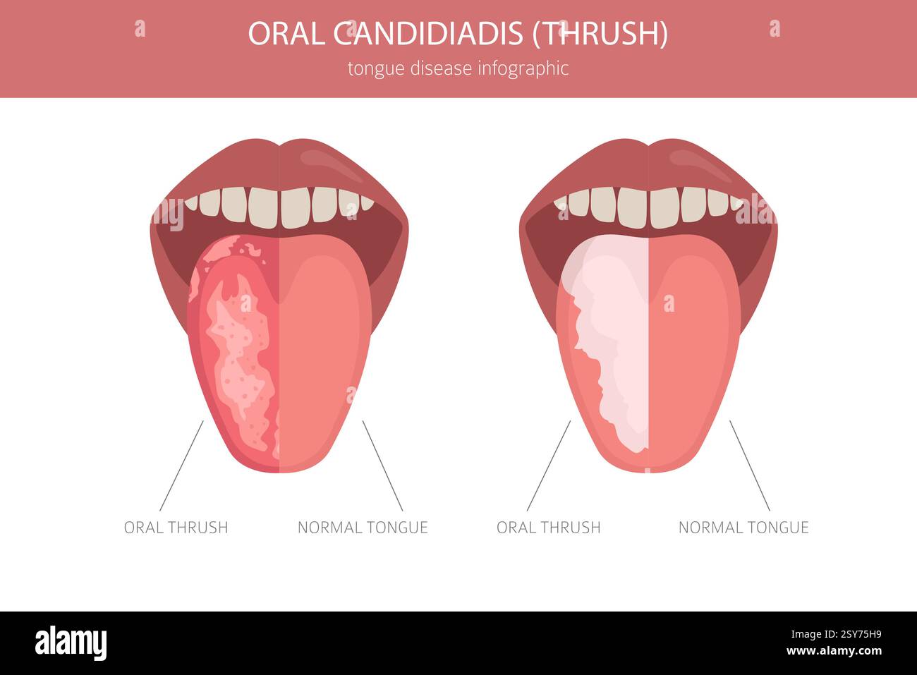 Oral thrush. Oral candidiadis disease. Medical infographic design ...