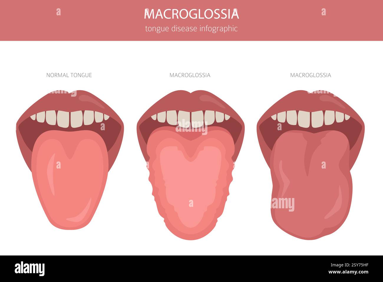 Macroglossia tongue disease. Oral medicine. Medical infographic design ...