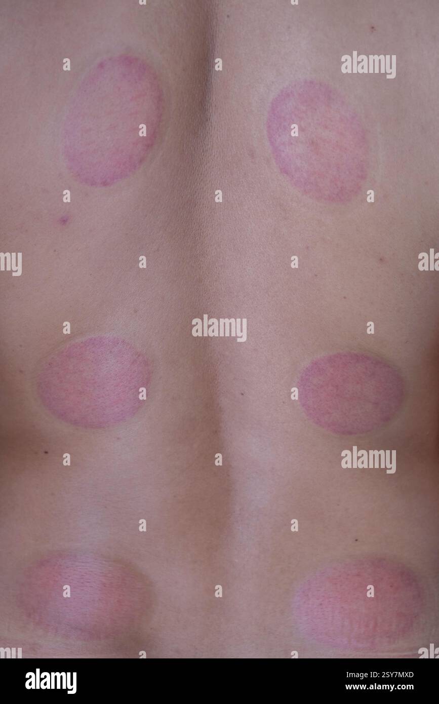 Close-up of scars after traditional therapy called bekam or cupping ...