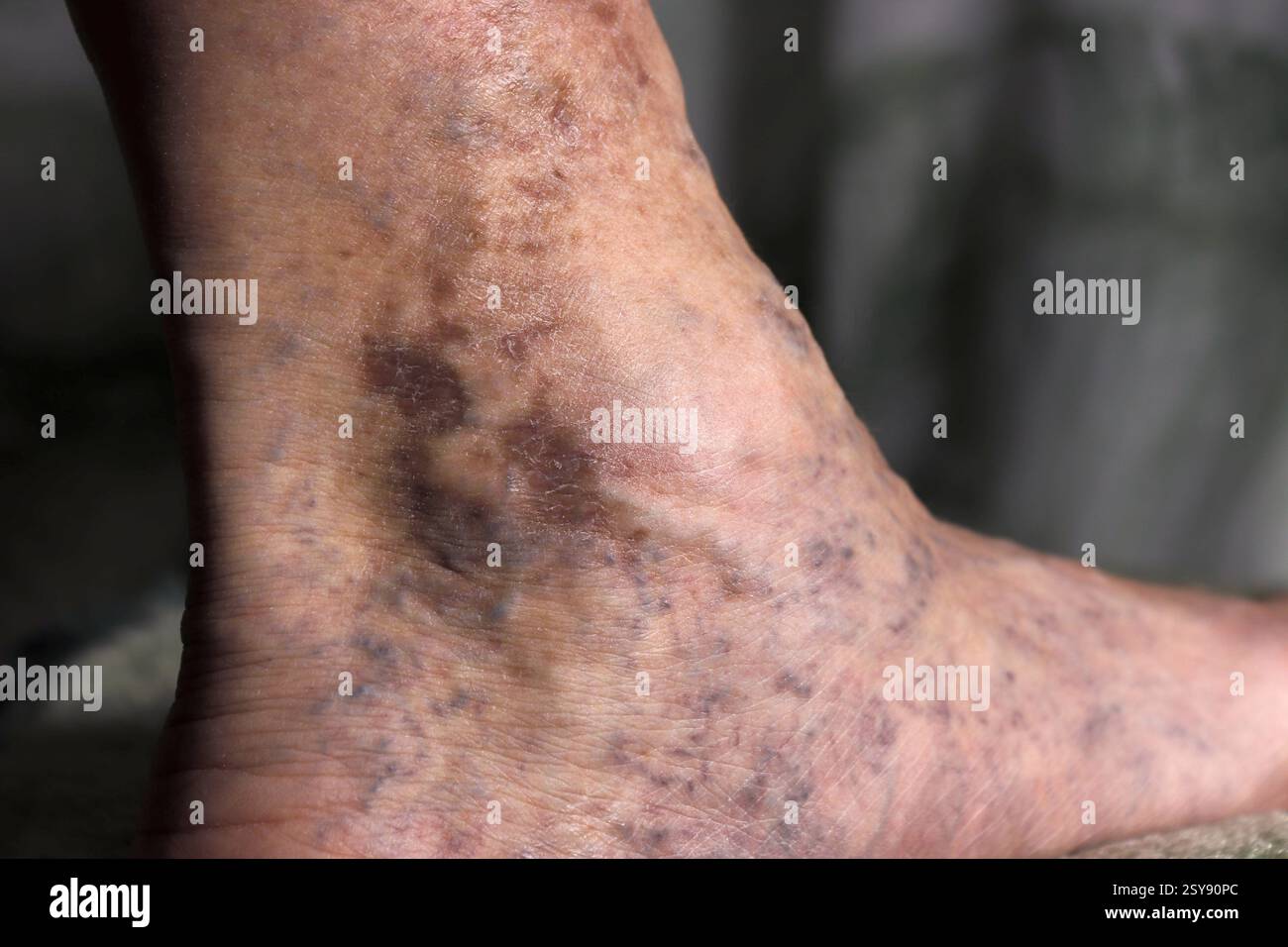 A human leg with clearly visible red spots is a consequence of varicose ...