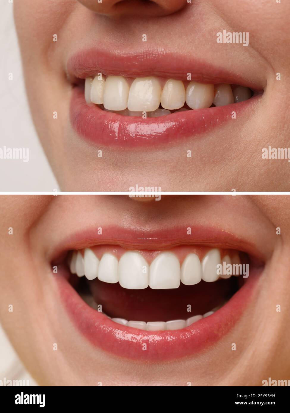 Woman smiling before and after procedure dental veneers placement ...
