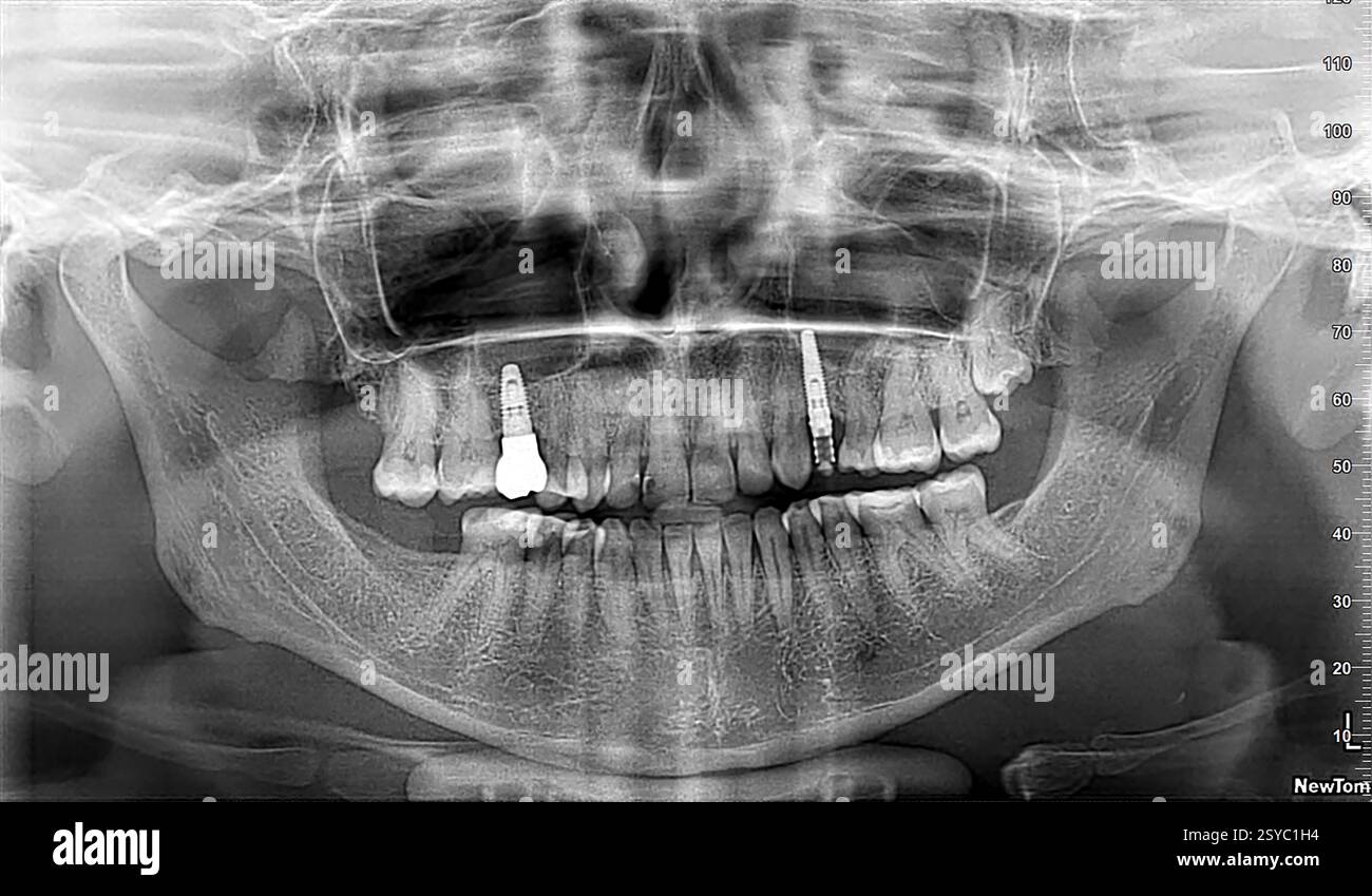 3D panoramic X-ray image of an adult female's teeth with dental implant ...