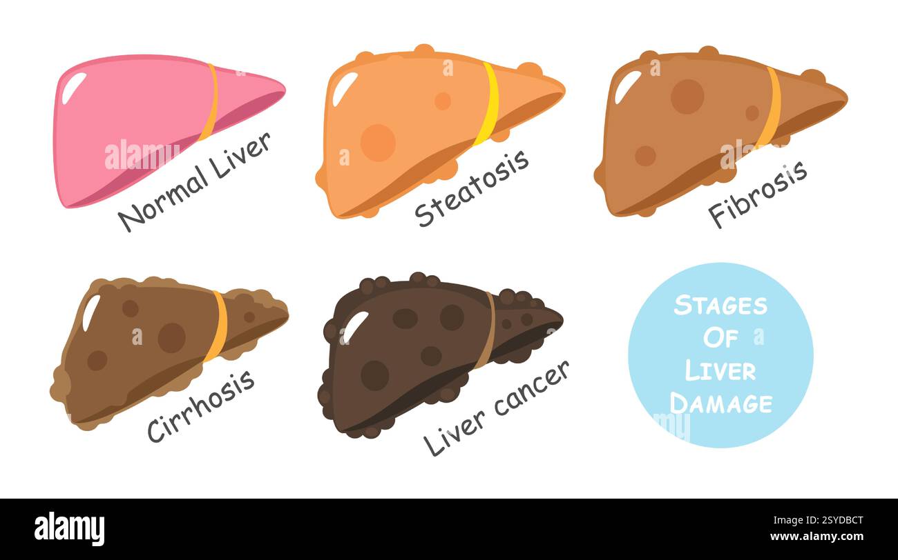 Stages of liver damage include steatosis or fatty liver, fibrosis ...