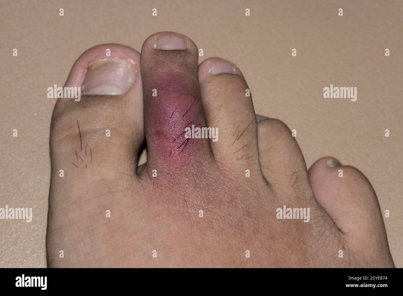Bruised and swollen toes Stock Photo - Alamy