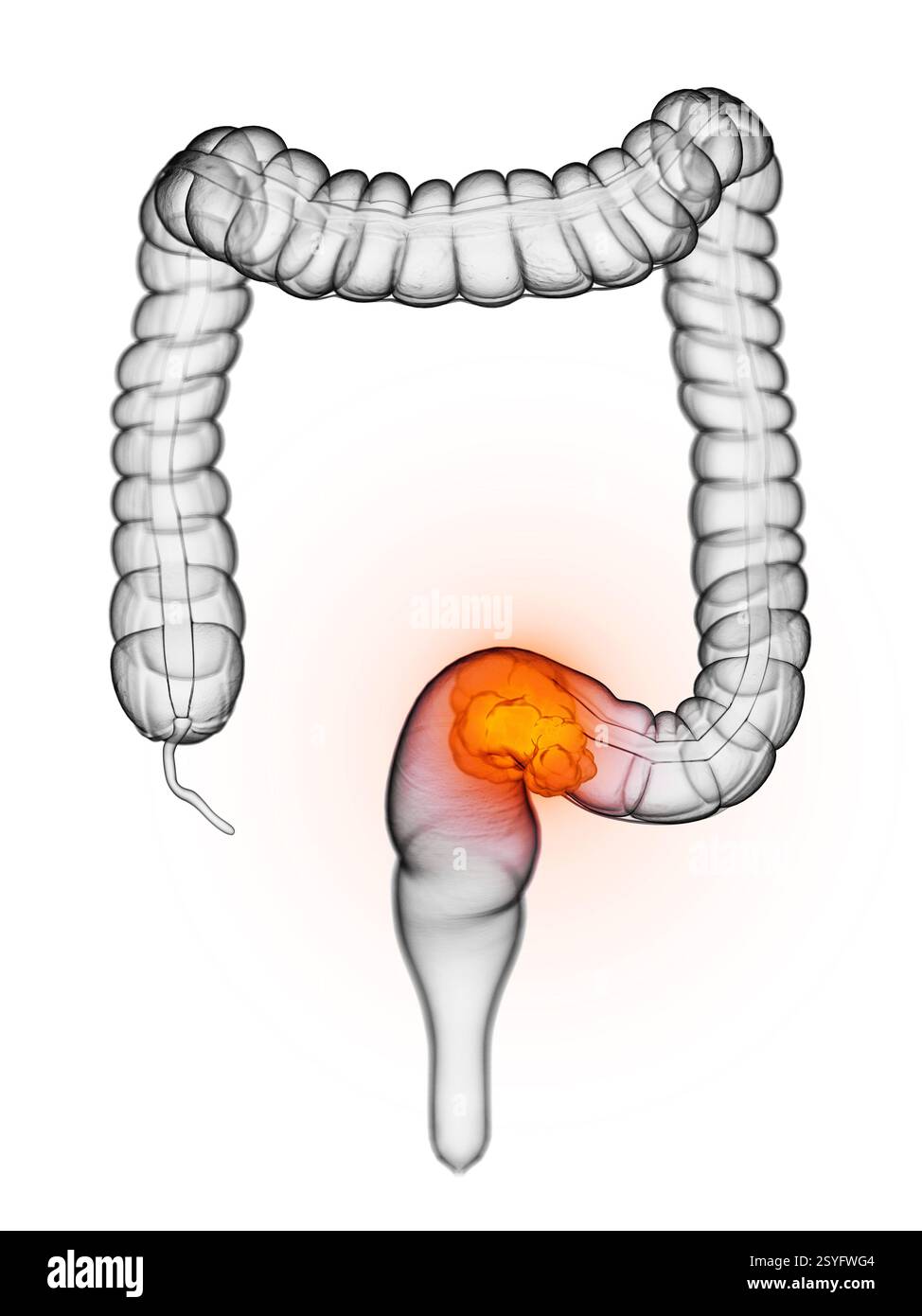 Cáncer colorectal Cut Out Stock Images & Pictures - Alamy