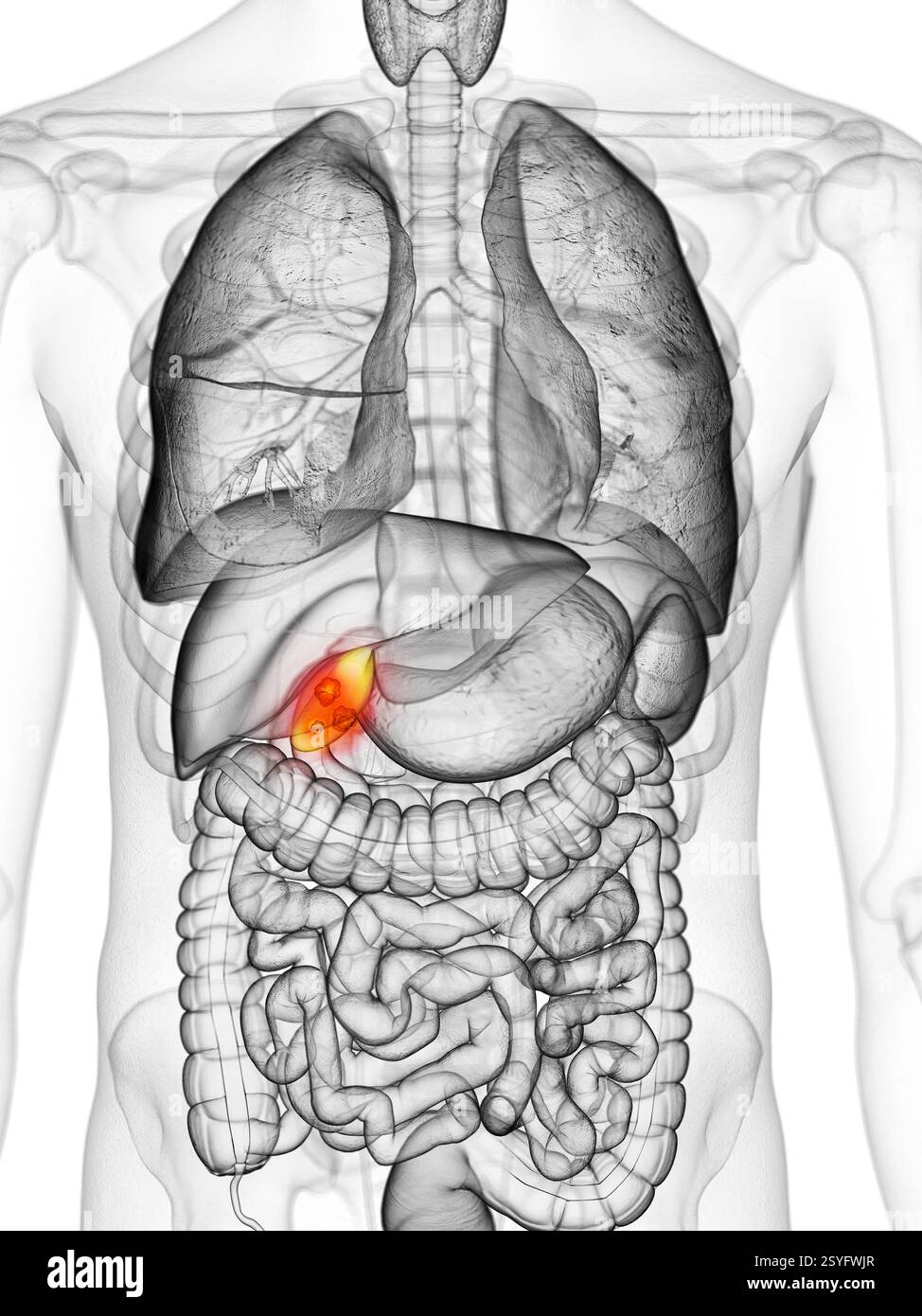 Gallbladder cancer, illustration Stock Photo - Alamy