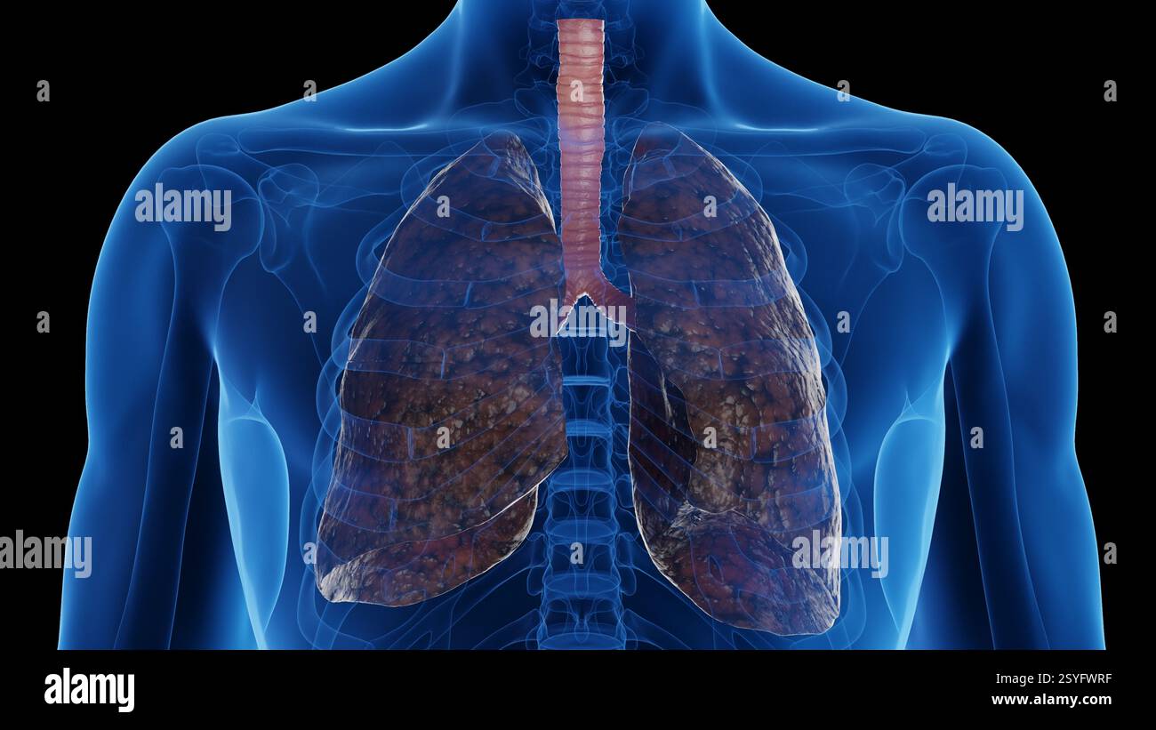 Healthy lung and smokers lung hi-res stock photography and images - Alamy