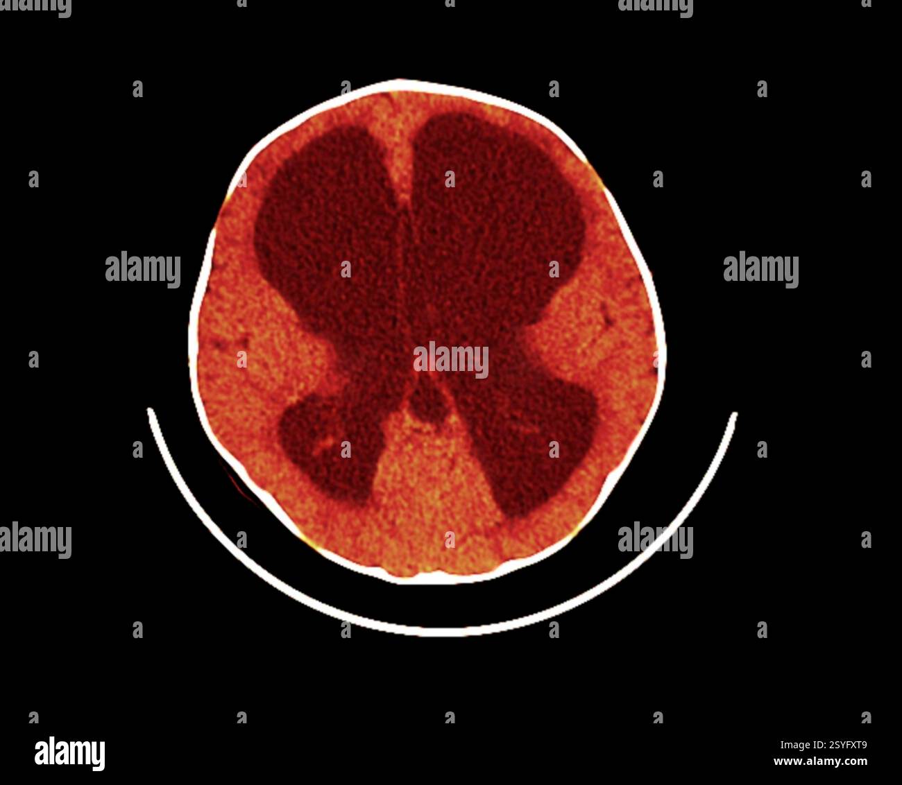 Coloured computed tomography (CT) scan of the brain of a child with ...