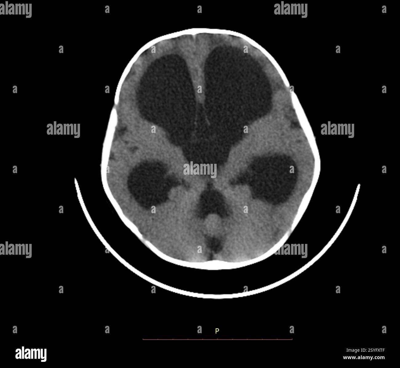 Computed tomography (CT) scan of the brain of a child with ...
