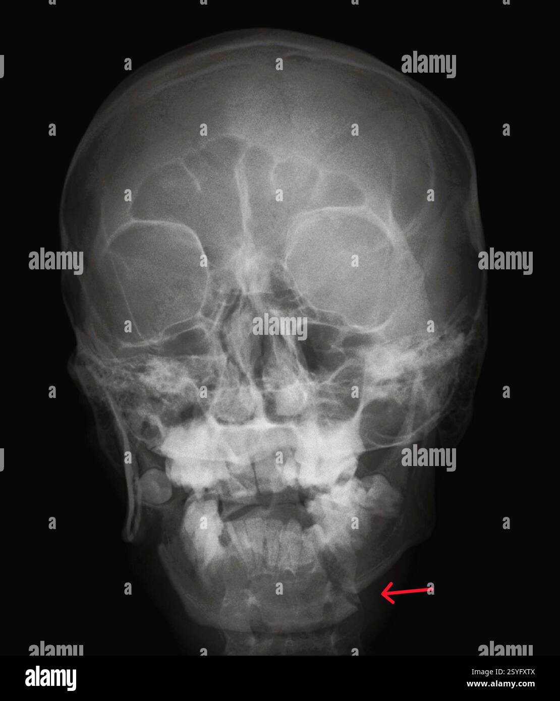 X-ray of the head of a patient with a fractured lower jaw (mandible ...