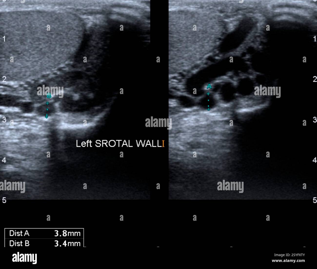 Ultrasound scans of a left scrotum with enlarged veins, a condition ...