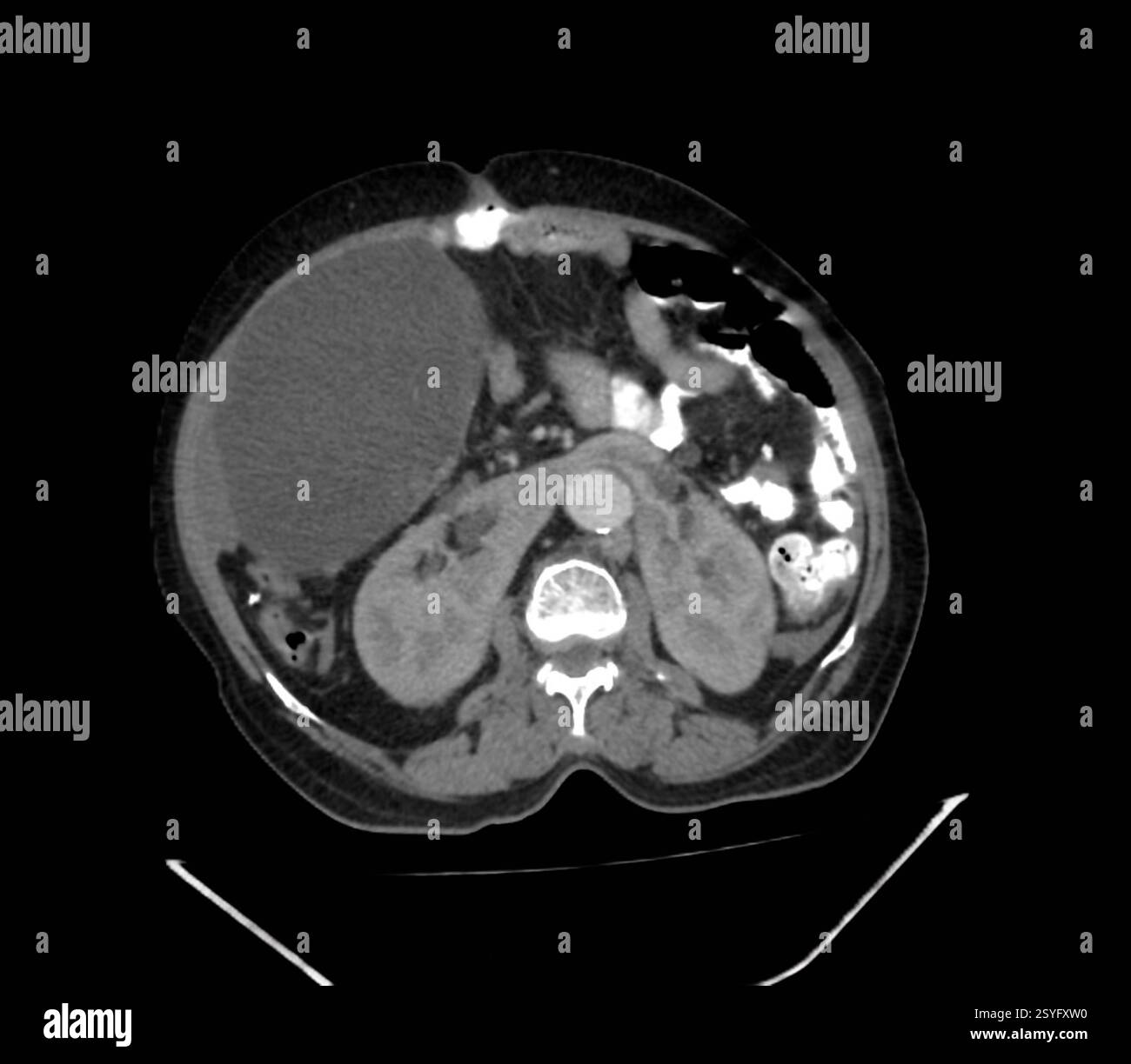 Kidney abnormality hi-res stock photography and images - Alamy