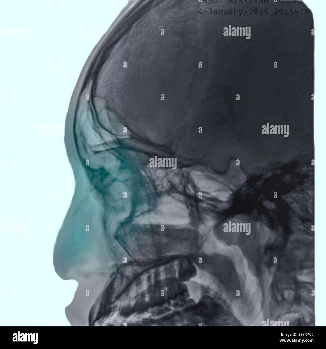 Coloured X-ray of the head of a patient with a broken nose Stock Photo ...