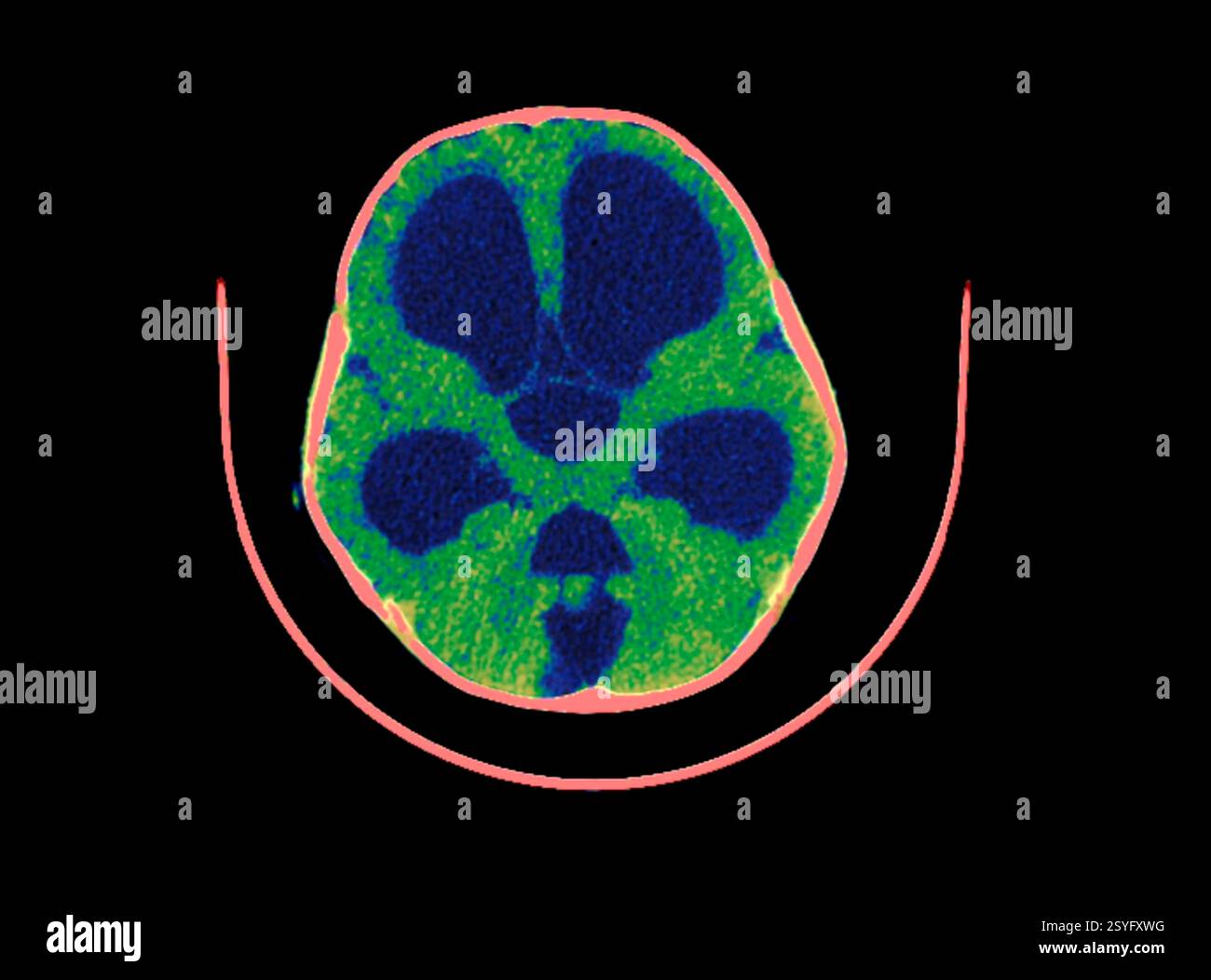 Coloured computed tomography (CT) scan of the brain of a child with ...