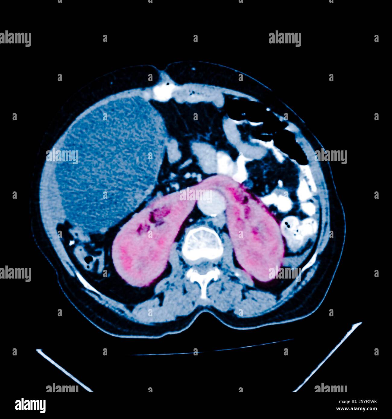 Coloured computed tomography (CT) scan of the abdomen of a patient with a horseshoe kidney (pink ...