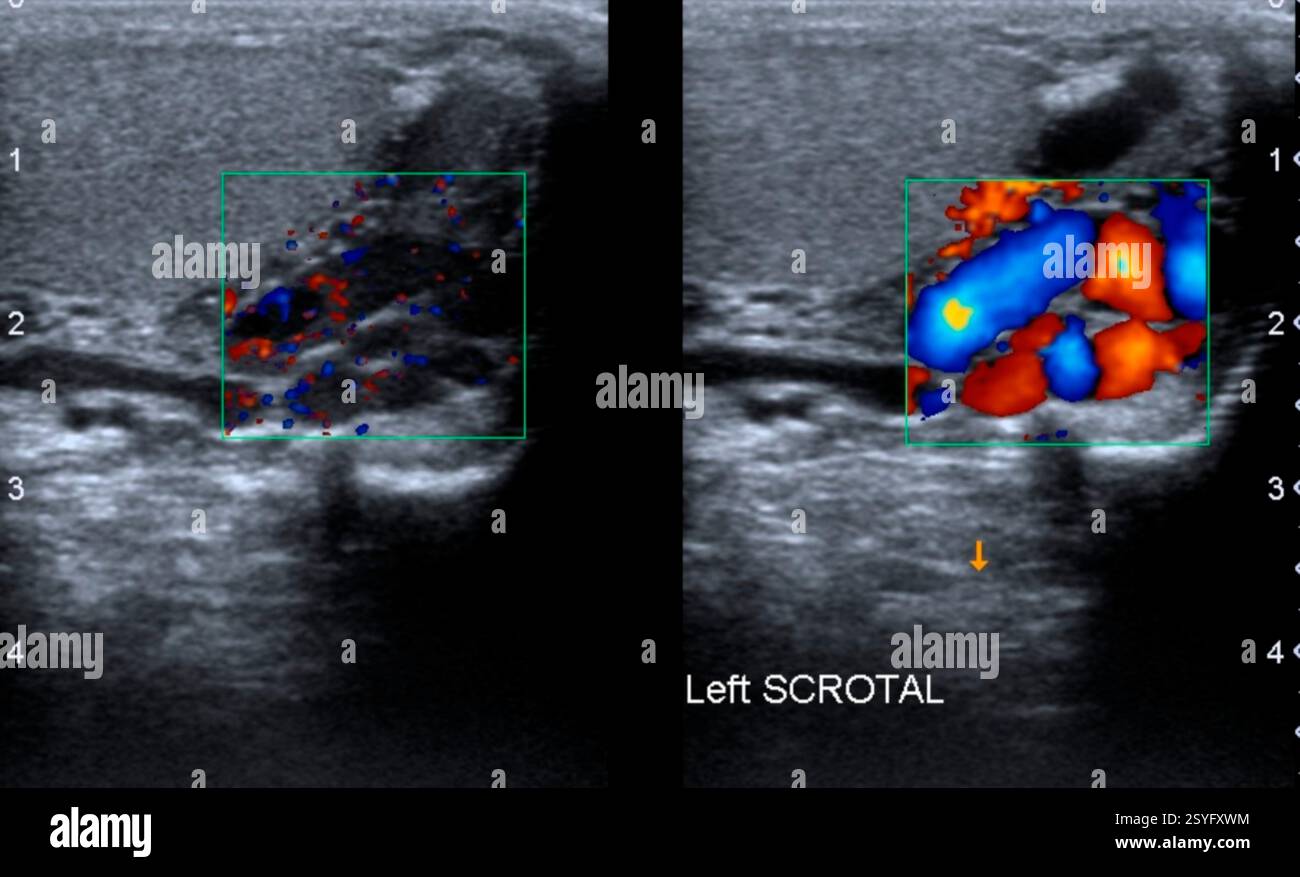 Doppler ultrasound scans of a left scrotum with enlarged veins, a ...