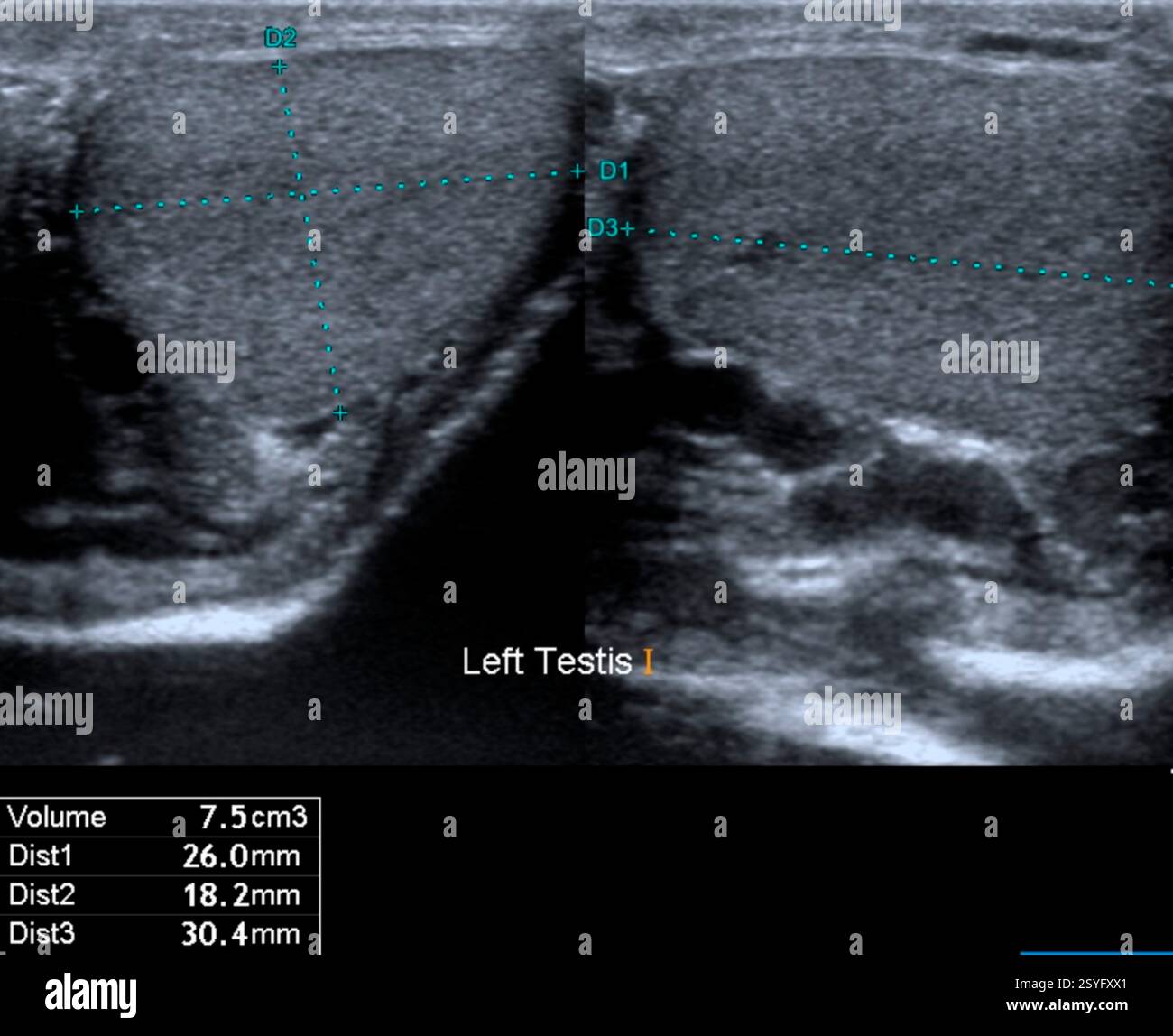 Ultrasound scans of a left testicle, part of the male reproductive ...