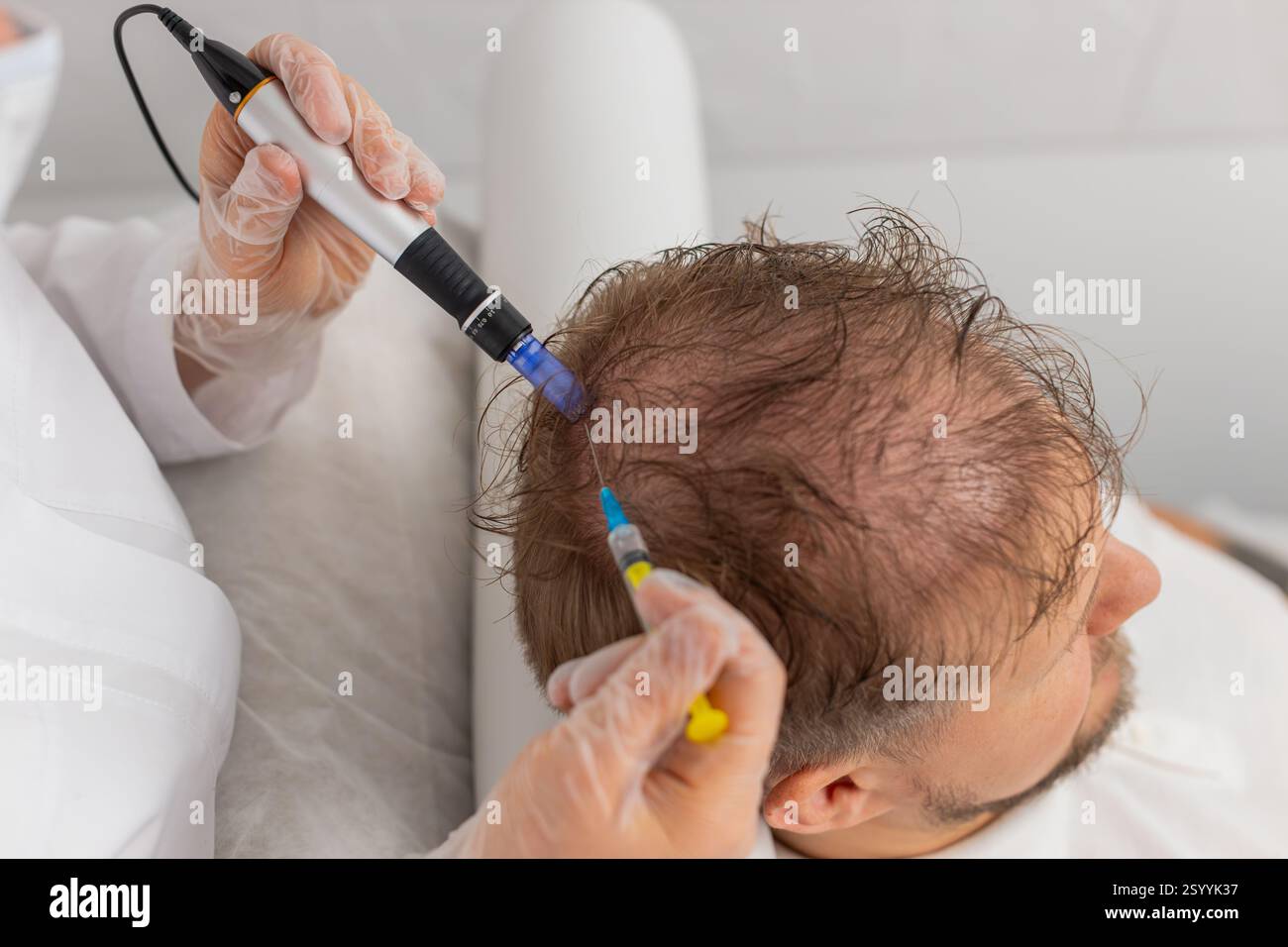 Alopecia. Man hair loss improve growth treatment regeneration, dermapen ...