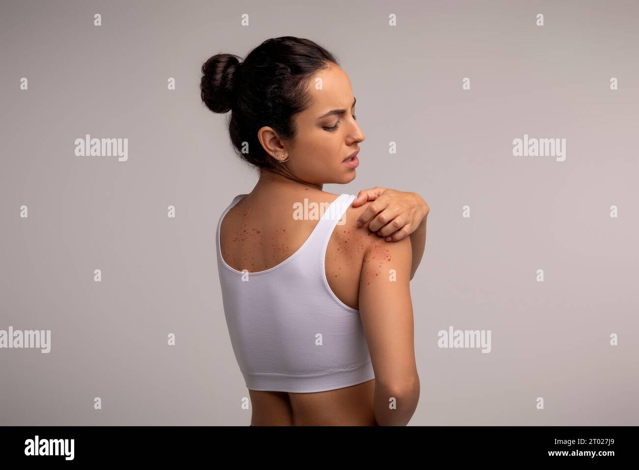 Brunette young woman scratching red spots on her skin Stock Photo - Alamy