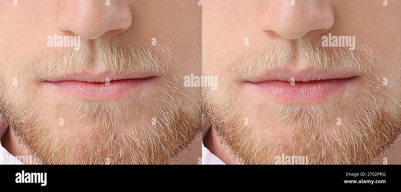 Young man before and after lip enhancement, closeup Stock Photo - Alamy