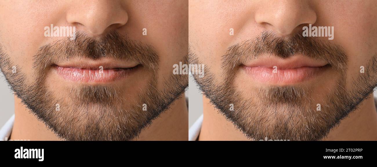 Young man before and after lip enhancement, closeup Stock Photo - Alamy